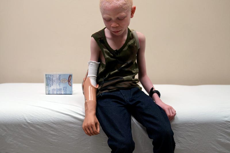Attacked for body parts, Tanzanian albino children get new limbs in US ...